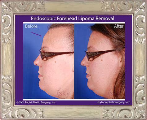 Endoscopic Forehead Procedures San Diego Lipoma Osteoma Brow — Sky