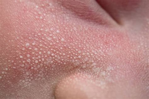 Small Itchy Pus Filled Bumps On Face Printable Templa