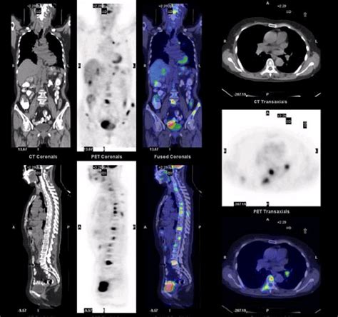 Pet Ct