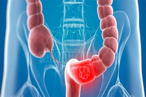 Hoy Tamaulipas A Mayoria De Pacientes Les Detectan Cancer De Colon En Etapas Avanzadas