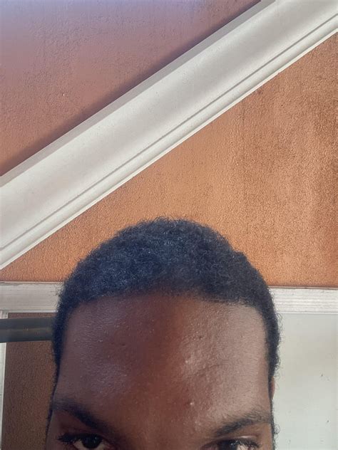 Asli Tarcan 5 Months And A Half Hair Transplant Rhairtransplants