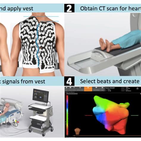 Pdf Noninvasive Electrocardiographic Imaging A Novel Tool For Understanding Atrial
