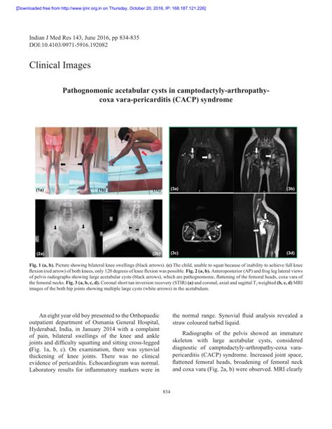 Pdf Pathognomonic Acetabular Cysts In Camptodactyly Arthropathy Coxa