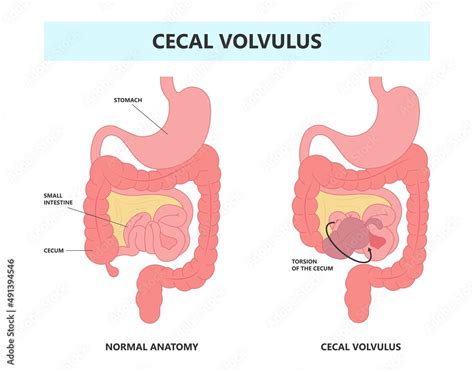 Timpanismo Cecal At Ina Peterson Blog