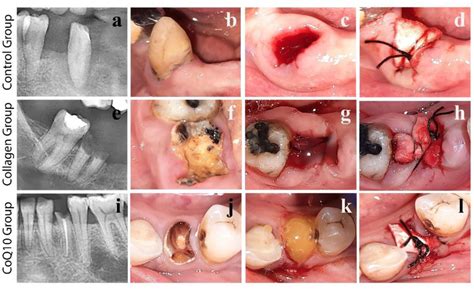 Tooth Extraction Before Wedding Extraction Of A Tooth With