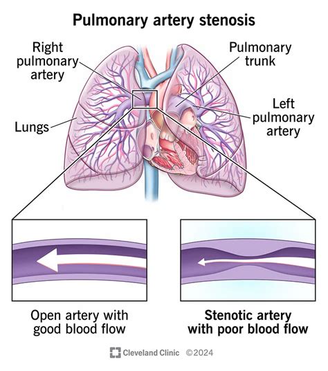 Pulmonary Artery Pulmonary Hypertension Right Heart Catheterization