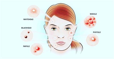 Types Of Acne Breakouts There Are Different Types Of Acne Breakouts Some Serious And Some Go