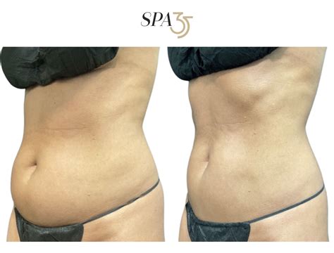 Spa 35 Med Spa Botox Laser Hair Removal Medical Weight Loss