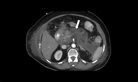 Acute Pancreatitis Update On Management The Medical Journal Of Australia