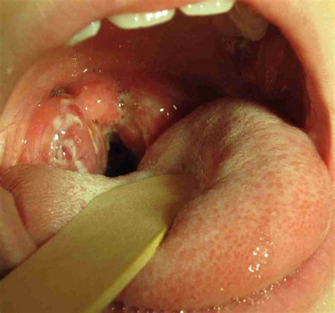 The Complete Guide To Streptococcal Pharyngitis Symptoms Treatment And Prevention 5 Minute