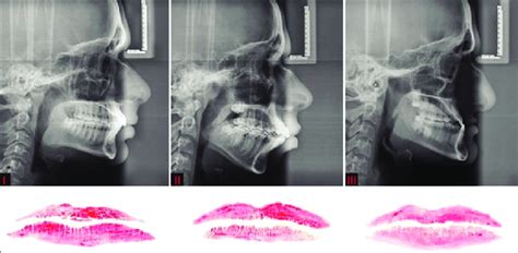 Cephalometrics Along With Lip Prints Download Scientific Diagram