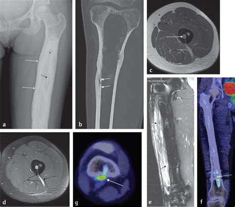 Osteomyelitis X Ray Features