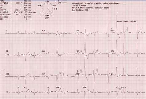 Ecg Quiz 18