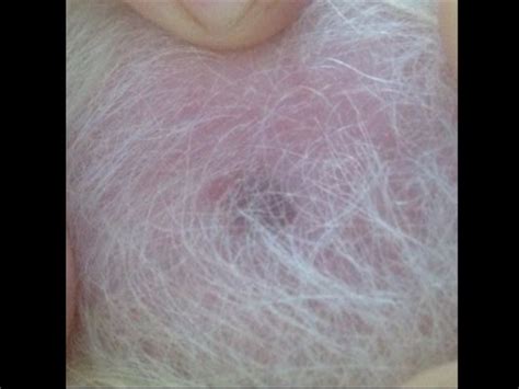 Derm Dx A Hairdresser Notices A Scalp Lesion On Her Client Clinical Advisor