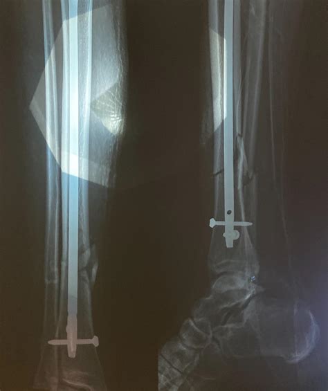 Broken Tib Fib With A Titanium Rod Two Screws Below The Knee And Two