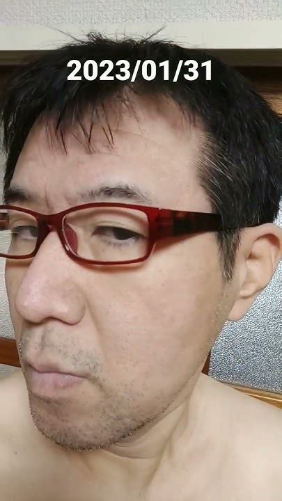 脱ステ174日目20230131 肌荒れ 脱ステロイド 酒さ 酒さ様皮膚炎 肌断食 Youtube