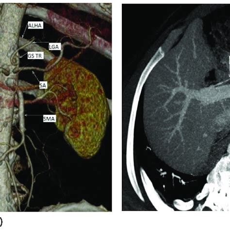 Mdct Angiography Of The Aa And Liver Female Patient 83 Years Old