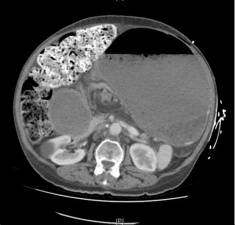 Reversed Bowel Rotation With Midgut Volvulus And Inte