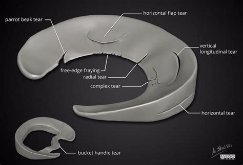 Meniscal Tear Types Illustration By Dr Matt Skalski Twitter