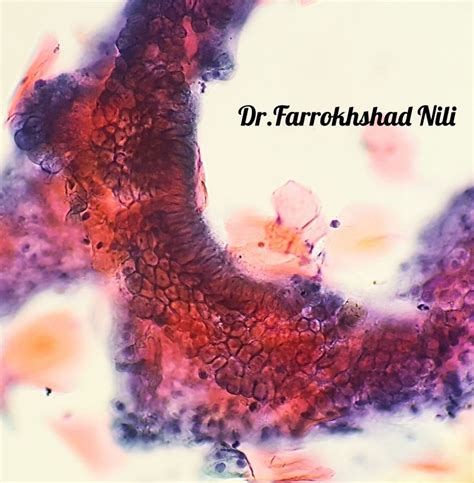 Tissue Fragment Of Endocervical Cells In Pap Smear You Can See Both