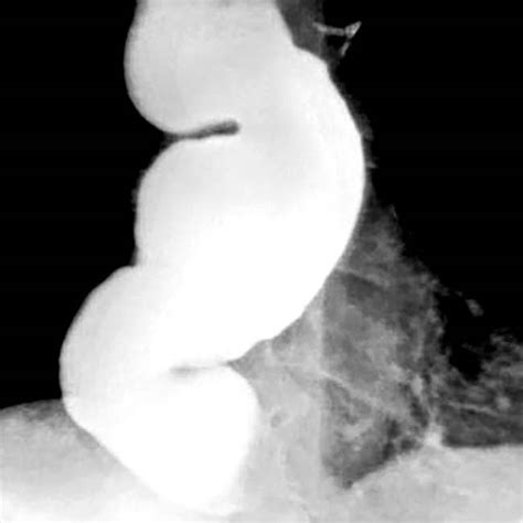 Esophageal Achalasia Radiology Key