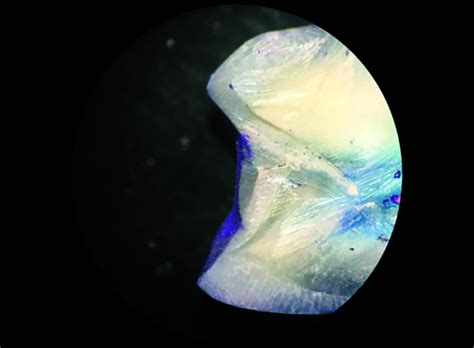 Evaluation Of Microleakage Of Different Types Of Pit And Fissure Sealants An In Vitro