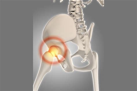 Capsur Enterprises On Linkedin What Are The Benefits Of Orthopedic