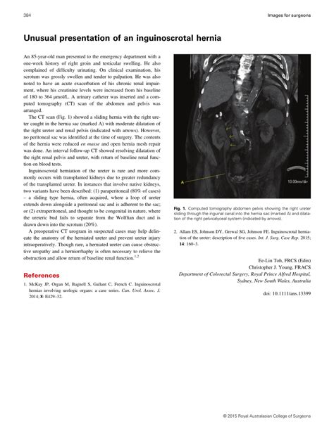 Pdf Unusual Presentation Of An Inguinoscrotal Hernia
