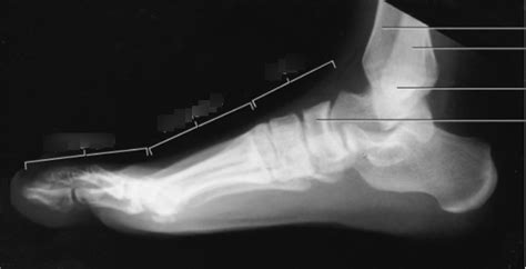 Left Foot Lateral Diagram Quizlet