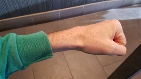 Draining Steve The Huge Ganglion Cyst On My Wrist With Aspiration