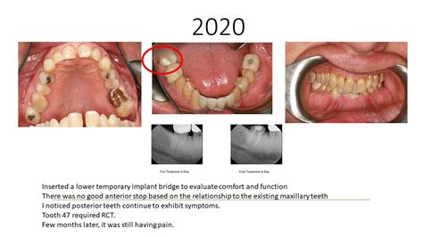 Missing The Signs Of An Occlusal Collapse Dr Beatrice Leung