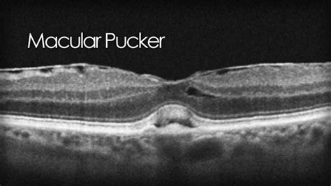 What Is Macular Pucker A Guide To Causes And Treatments