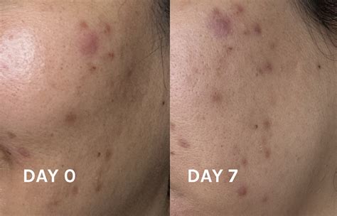 My Epiduo Experience Day 7 — Project Vanity