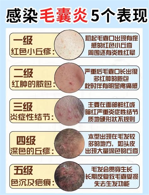 毛囊炎的五种类型及自愈可能