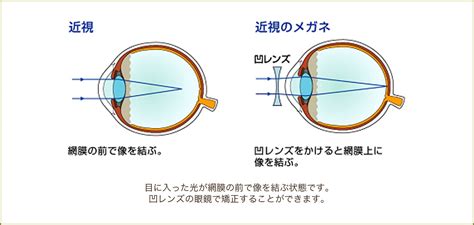 屈折異常 ひきち眼科 北海道札幌駅徒歩3分