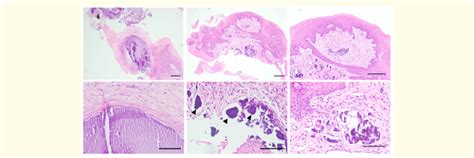 Histopathological Image Of Lingual Calcinosis Circumscripta The Tongue
