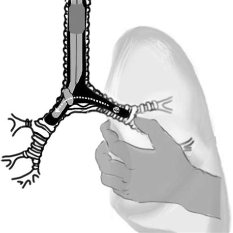 Pdf Bronchial Obstruction By Tumor Embolus Of Contralateral Lung During Pneumonectomy Report