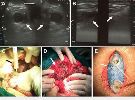 Peritoneal Abscess Appendix