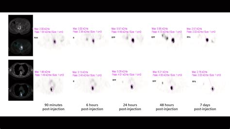 Tumor And Organ Dosimetry From Sequential Quantitative Spectct
