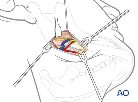 Contralateral Depressor Angularis Muscle Excision For Irreversible