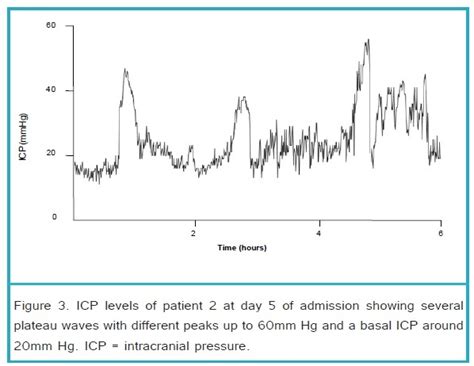 Icp Waveforms Abc Waves
