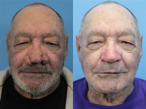 Rhinophyma Before After