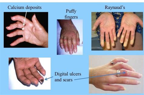 Pin On Scleroderma