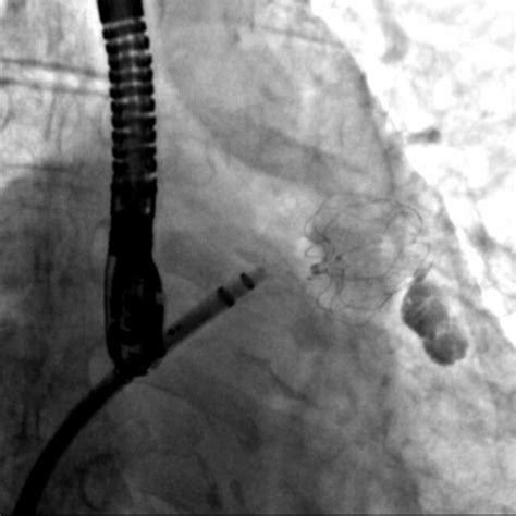 Final Position Of Watchman Device Number 27 Mm In Left Atrial Appendage Download Scientific