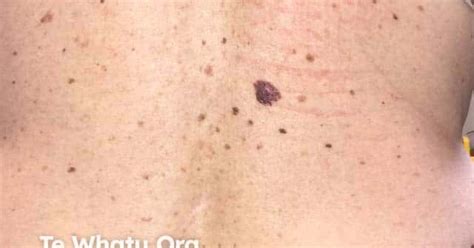 Superficial Spreading Melanoma Image