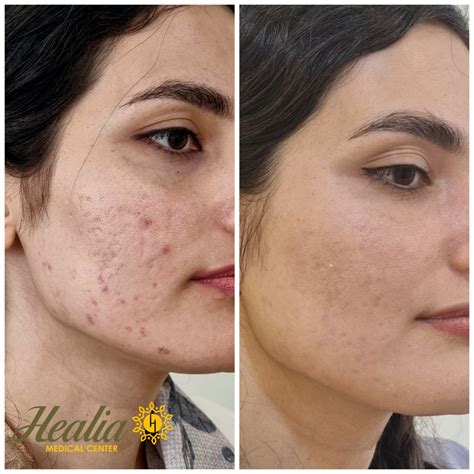 Everything You Need To Know About Laser Acne Scar Removal Healia