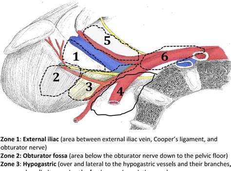 Hypogastric Lymph Nodes