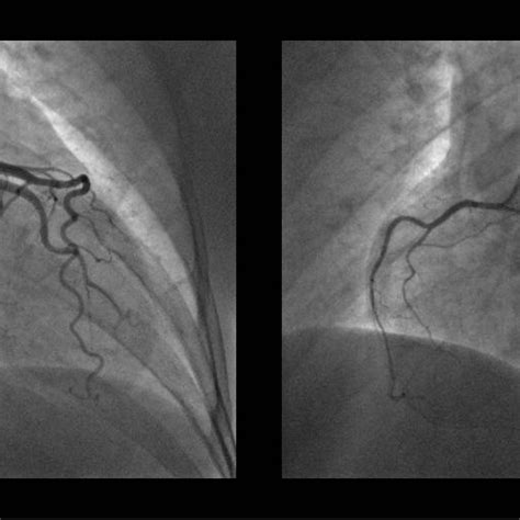 Normal Coronary Angiogram On Adssion At Left Left Coronary Artery At