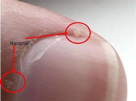 Home Remedies For Hangnails Healthylife Werindia