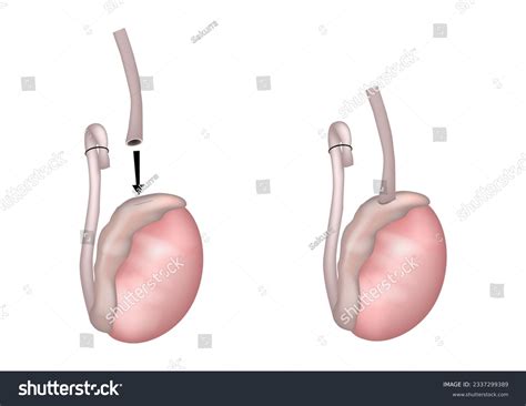 Vasovasostomy Over 1 Royalty Free Licensable Stock Illustrations